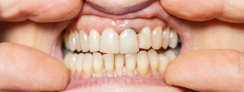 Retracción de las encías: causas y tratamiento