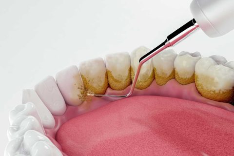 Sarro en los dientes: qué es y cómo evitarlo eficazmente - Clínica ...